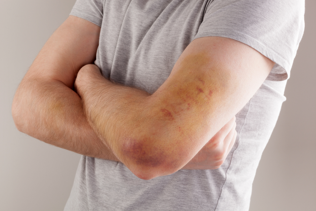 What Is Hemophilia And The Causes Of Hemophilia Ofwnow